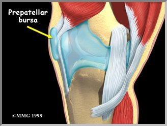 CalexFit, Foot Pain Relief Center - Conditions - Pre Patellar Bursitis